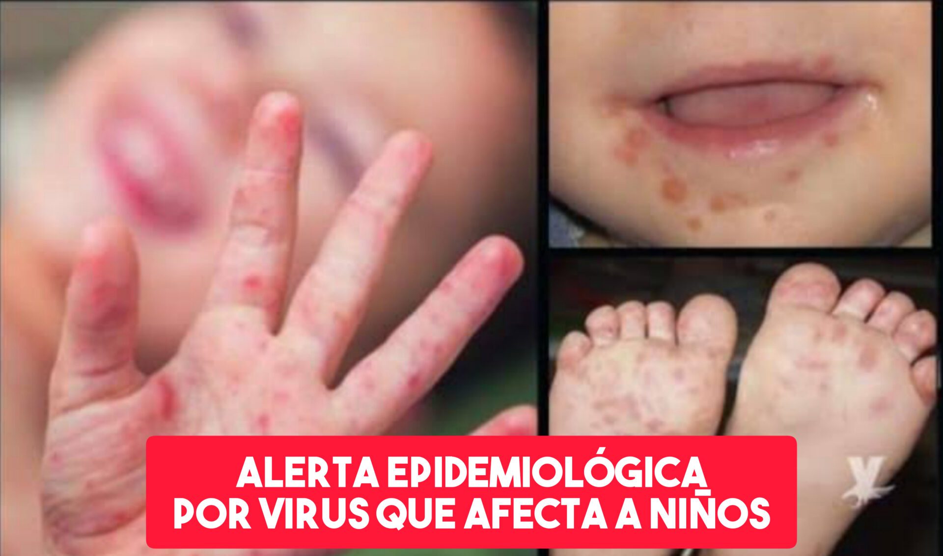 Minsa: alerta epidemiológica en 4 regiones por brote de virus que ...